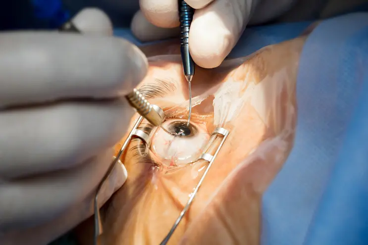 Toric Multifocal Lens Implantation Surgery