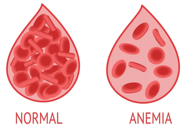 Understanding Anemia in Newborns: Causes, Symptoms, and Care