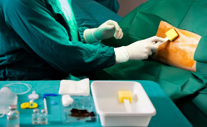 Neurolisis Epidural para el Alivio del Dolor