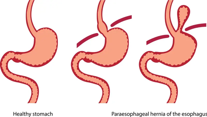 Stomach Hernia (Gastrocele) Treatment