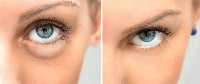 Under-Eye Fat Repositioning for a Youthful Look in Middle Age