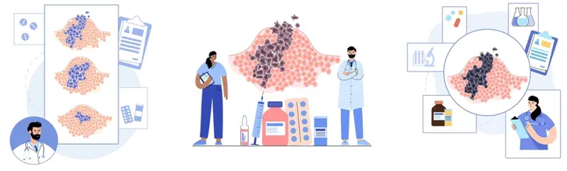 Basal Cell Carcinoma (Basalioma) Treatment