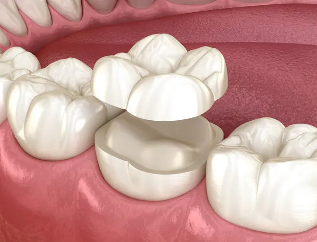 Restauraciones Inlay y Onlay CEREC