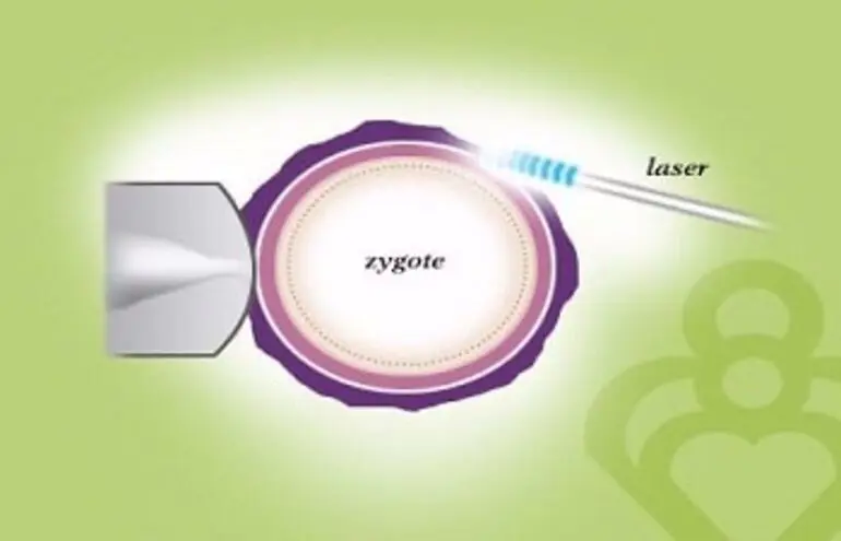 Laser-Assisted Hatching for IVF Embryos
