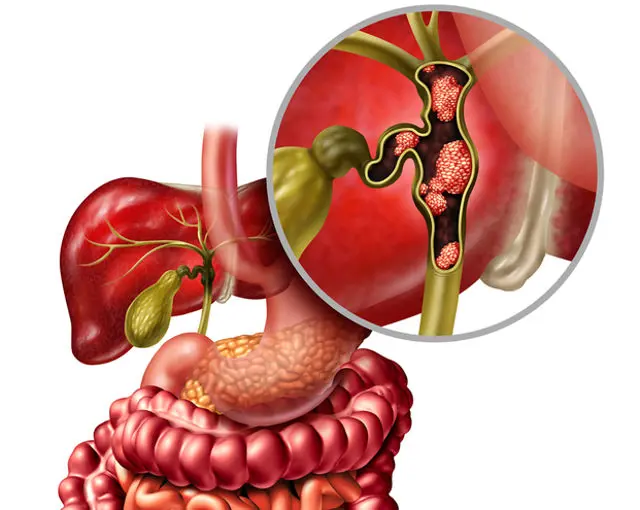 Biliary Disease Diagnosis and Treatment