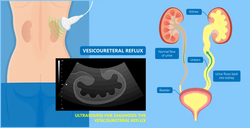 VUR (Vesicoureteral Reflux) Treatment