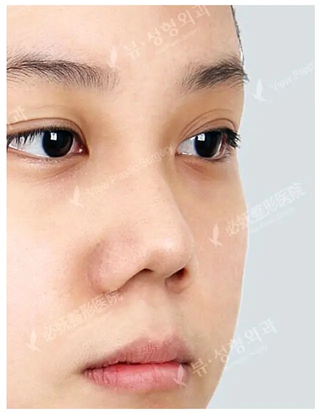 Nasal Alar Reduction Surgery