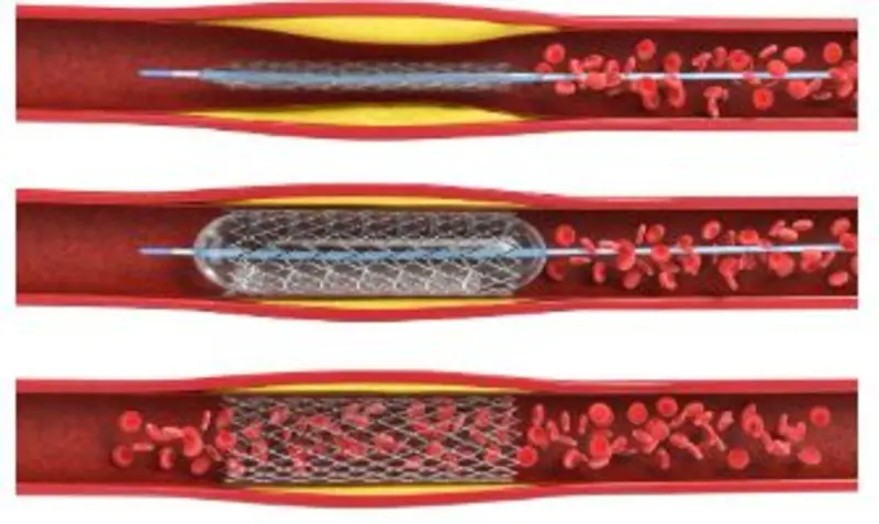 Cardiovascular Interventions