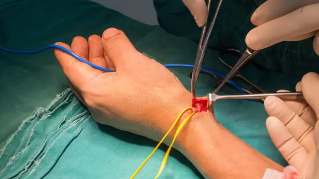 Arteriovenous Fistula for Dialysis: A Clinical Explanation