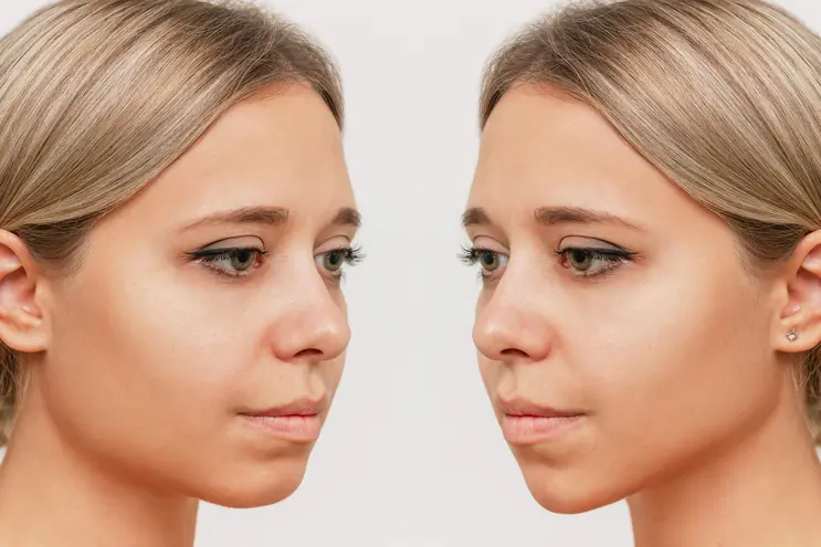 Reducción cigomática