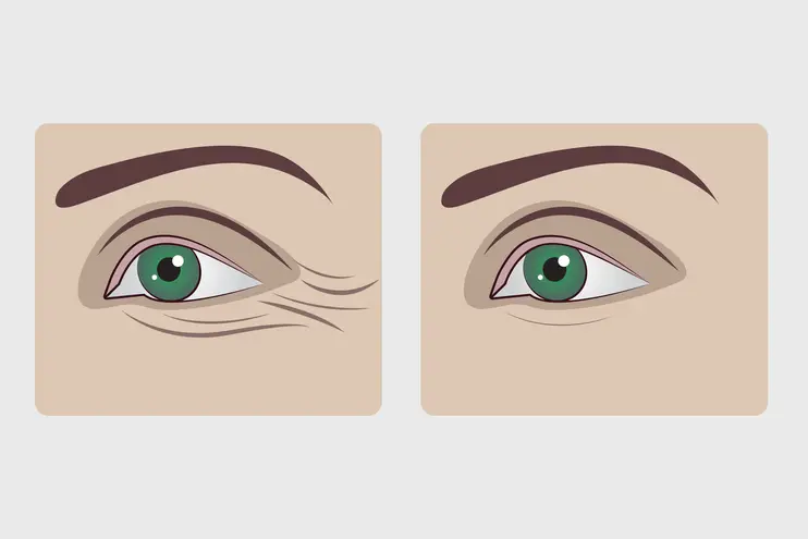Canthopexy: A Comprehensive Patient Guide to Eyelid Lifting and ...