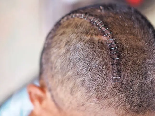 Brain Surgery (Craniotomy)