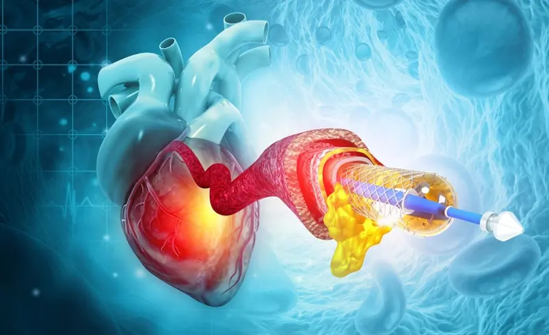 Rotational Atherectomy Procedure