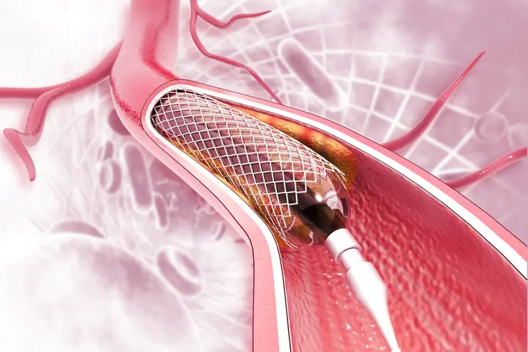 Procedimiento de Stent para COA (Coartación de la Aorta)