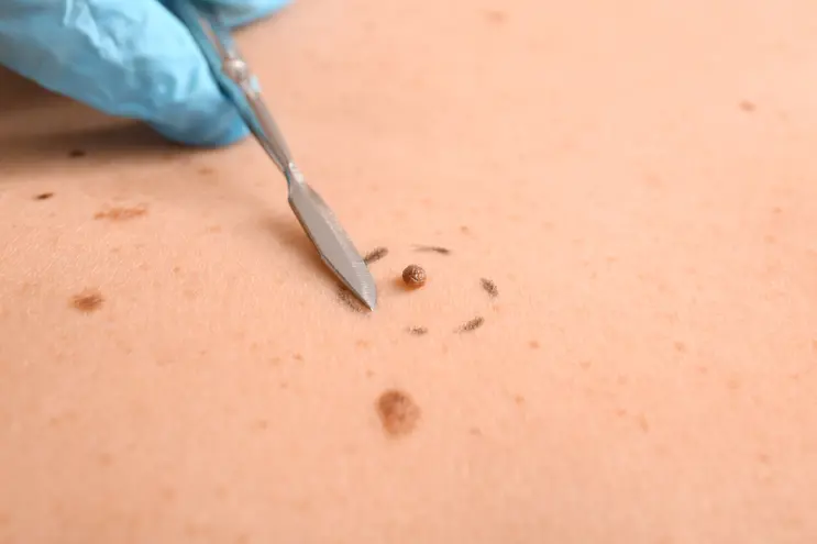 Mole Removal