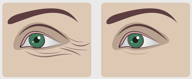 Canthopexy: A Comprehensive Patient Guide to Eyelid Lifting and ...