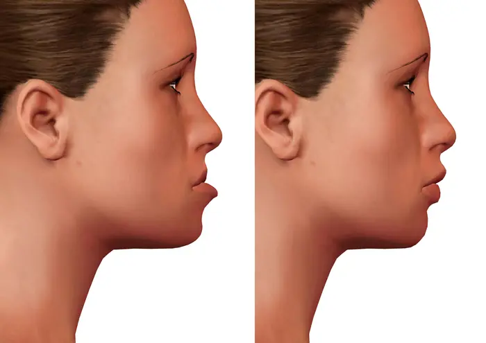 Jaw Deformity Diagnosis and Treatment