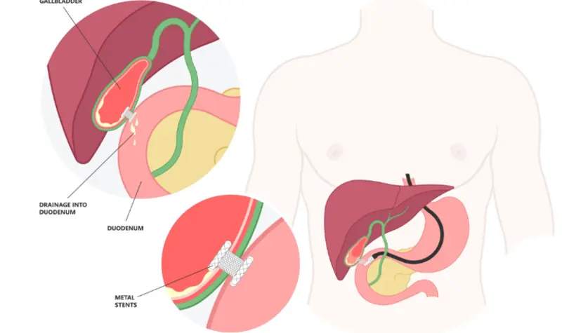 Endoscopic Bile Duct Surgery