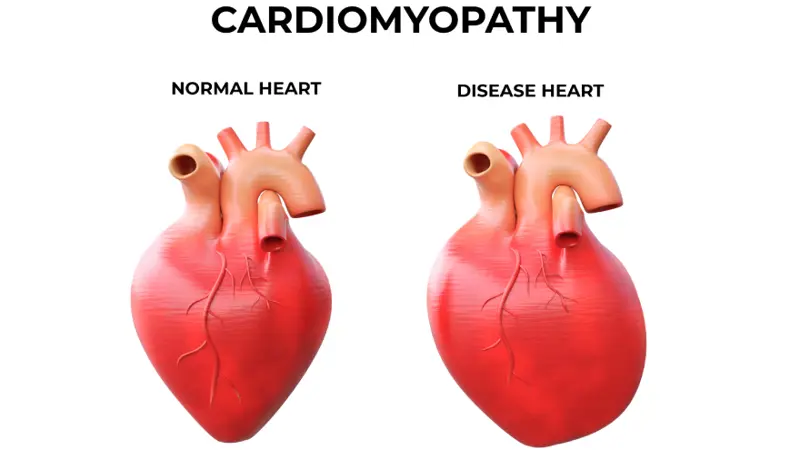Understanding Alcohol-Induced Cardiomyopathy: Causes, Symptoms, and ...