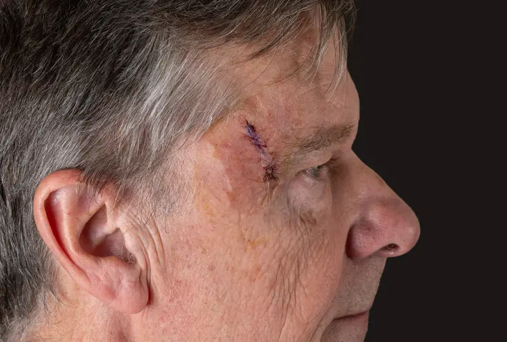 Basal Cell Carcinoma (Basalioma) Treatment