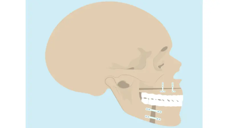 Bone Reshaping Surgery (Osteotomy)