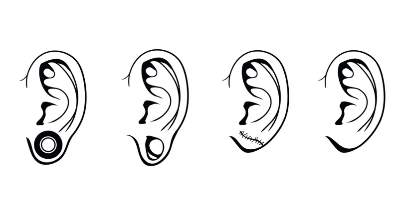 Effective Earlobe Repair: Safe Solutions for Restoring Your Ears