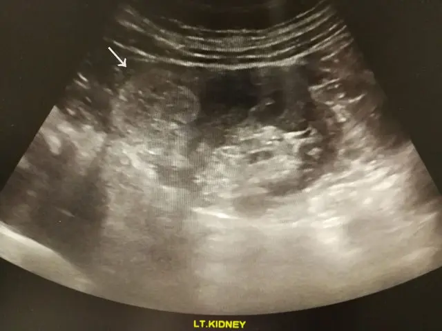 Angiomyoma Diagnosis and Treatment