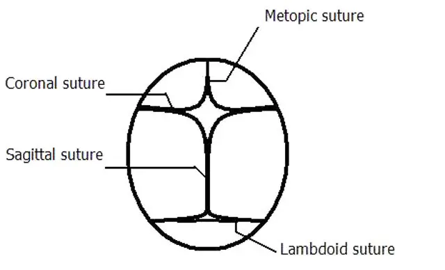 Craniosynostosis Surgery
