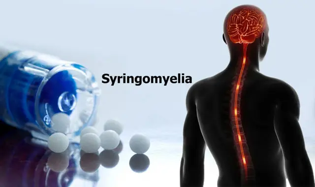 Syringomyelia Diagnosis and Care