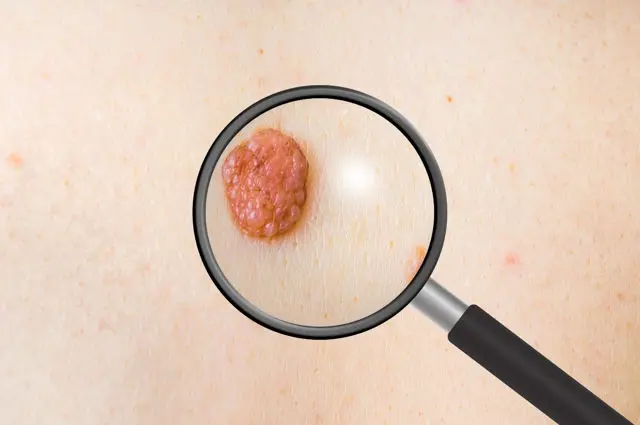 Angiomyoma Diagnosis and Treatment